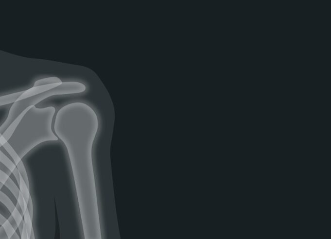 AC-Gelenk: Arthrose im Schultereckgelenk